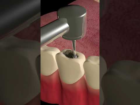 hidden cavity under tooth #shorts (tooth decay filling procedure) - Etoners