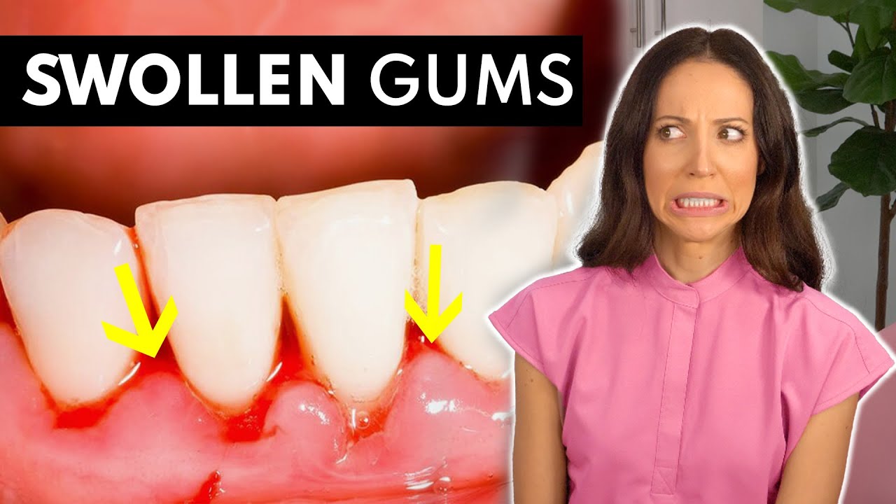What SWOLLEN GUMS Are Telling You & What To Do About It! - Etoners