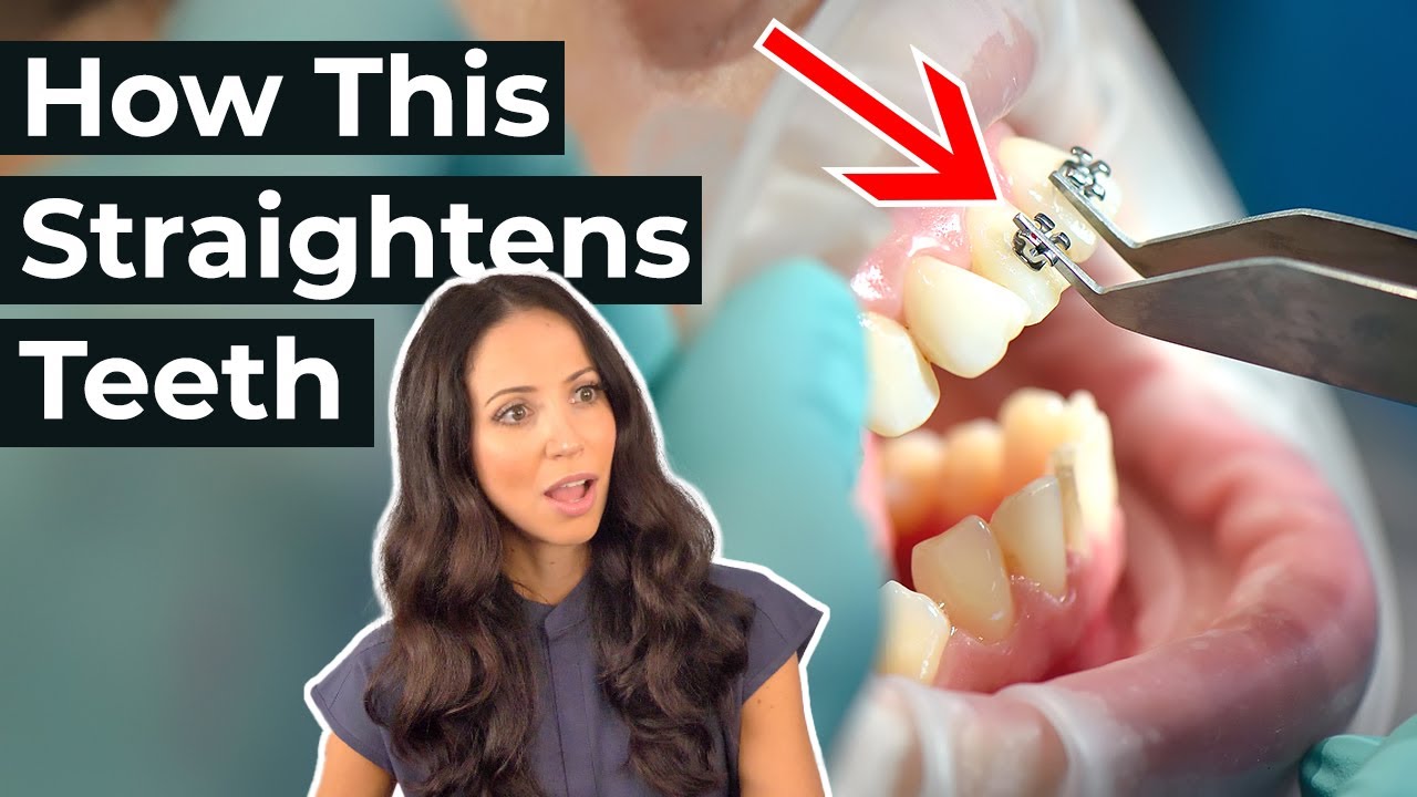 How Braces ACTUALLY Work - Etoners