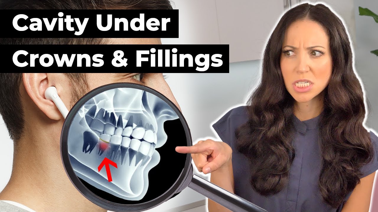Tooth Decay Under a Crown | Recurrent Decay Explained - Etoners