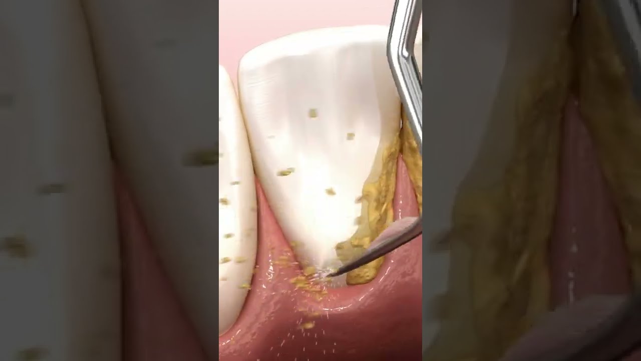 deep teeth cleaning #shorts (scaling and root planing procedure) - Etoners deep teeth cleaning #shorts (scaling and root planing procedure) - Etoners