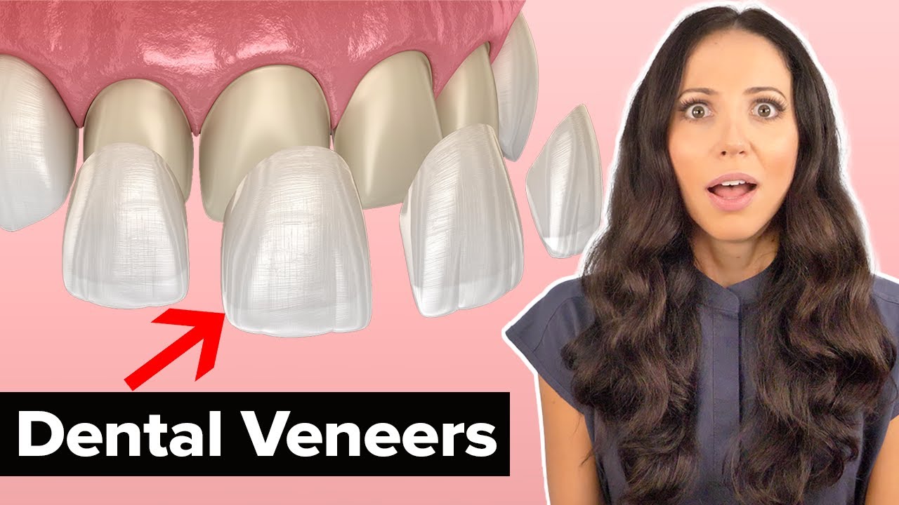 Dental Veneers Procedure Explained - Etoners
