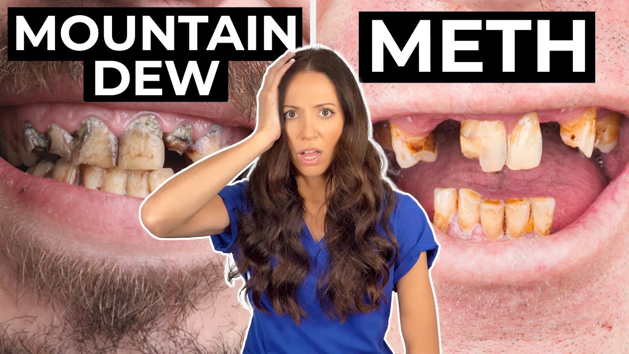 Meth Mouth or Mountain Dew Mouth... Which is WORSE? - Etoners