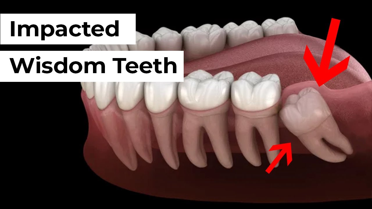 Impacted Wisdom Tooth Removal - Etoners