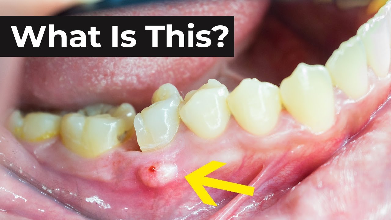 What is an Abscessed Tooth & What To Do About It - Etoners