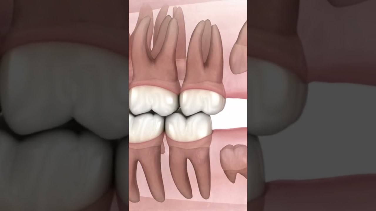 wisdom tooth eruption #shorts - Etoners