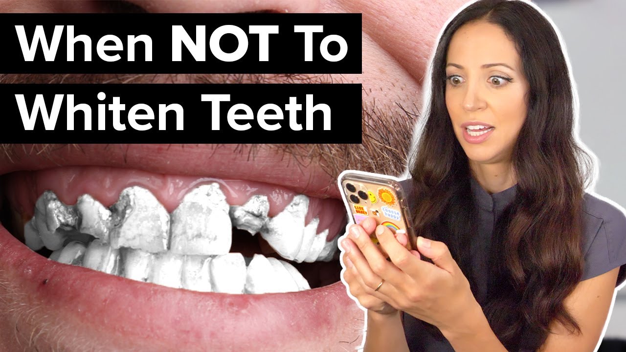 5 Reasons You Should NOT Whiten Your Teeth - Etoners