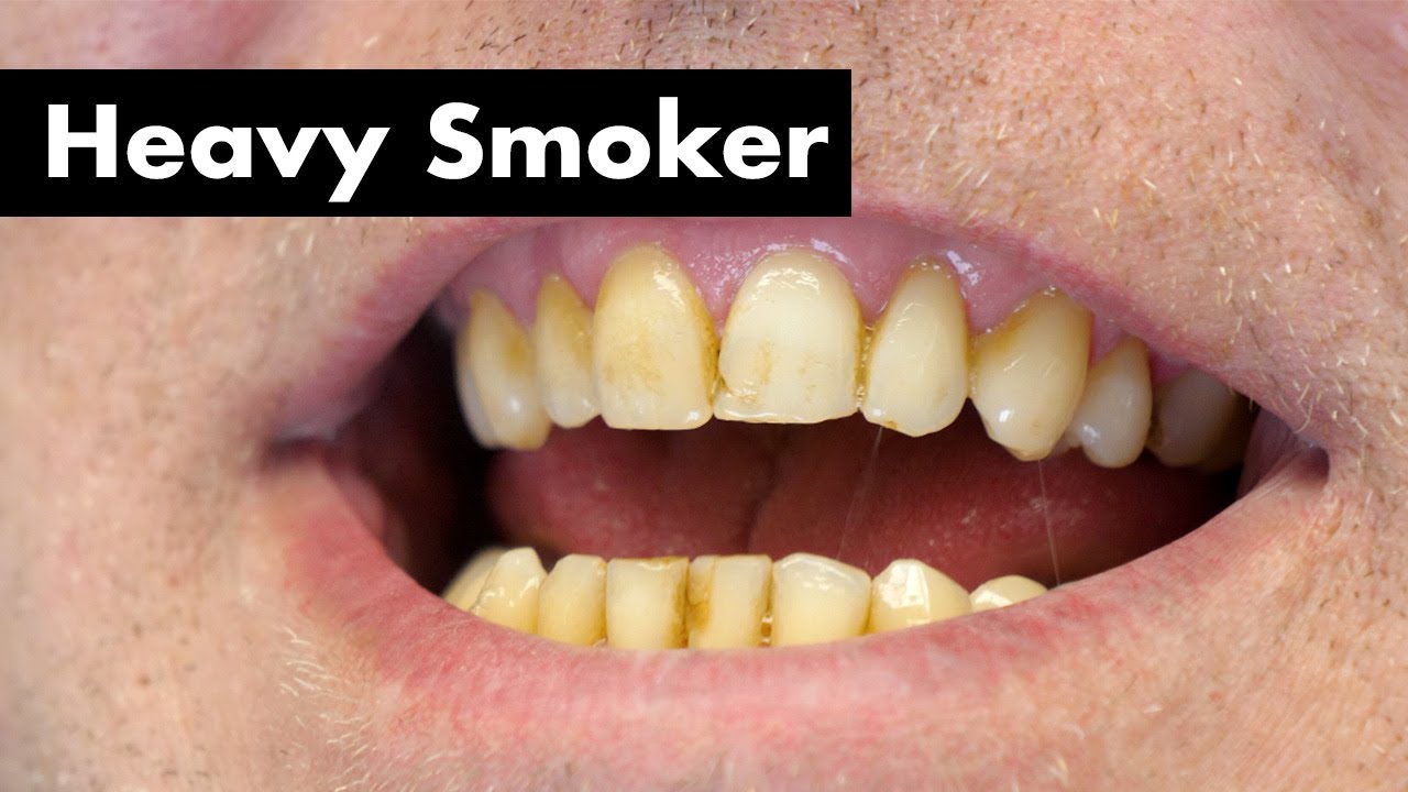 Cleaning Smoker's Teeth with Heavy Stain | Teeth Cleaning - Etoners
