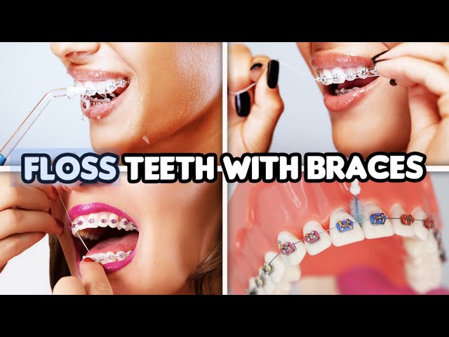 how to FLOSS your teeth WITH BRACES - Etoners
