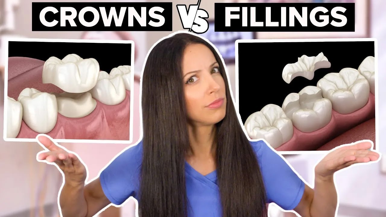 Dental Crowns Vs Dental Fillings (What's the Difference?) - Etoners