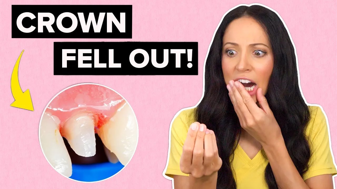 What to Do If Your Dental Crown Fell Out - Etoners