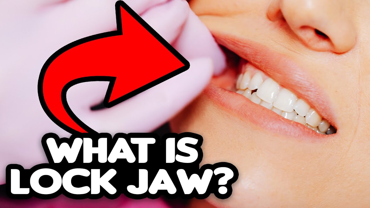 Lock Jaw Explained (causes, treatment, prevention) - Etoners
