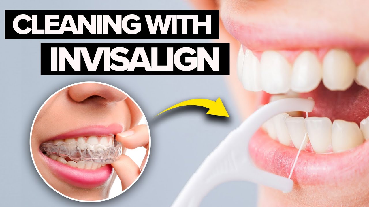 How To Care For Your Teeth During Invisalign - Etoners