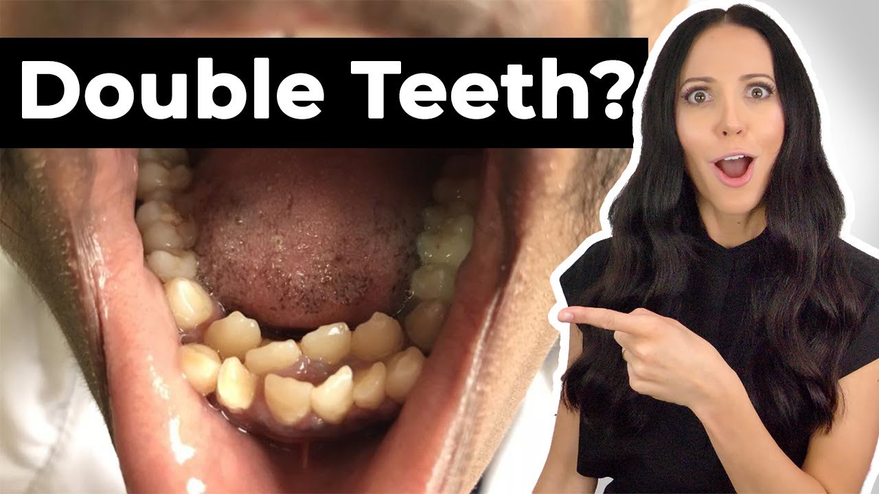 Why 3.8% of People Have Extra Teeth - Etoners