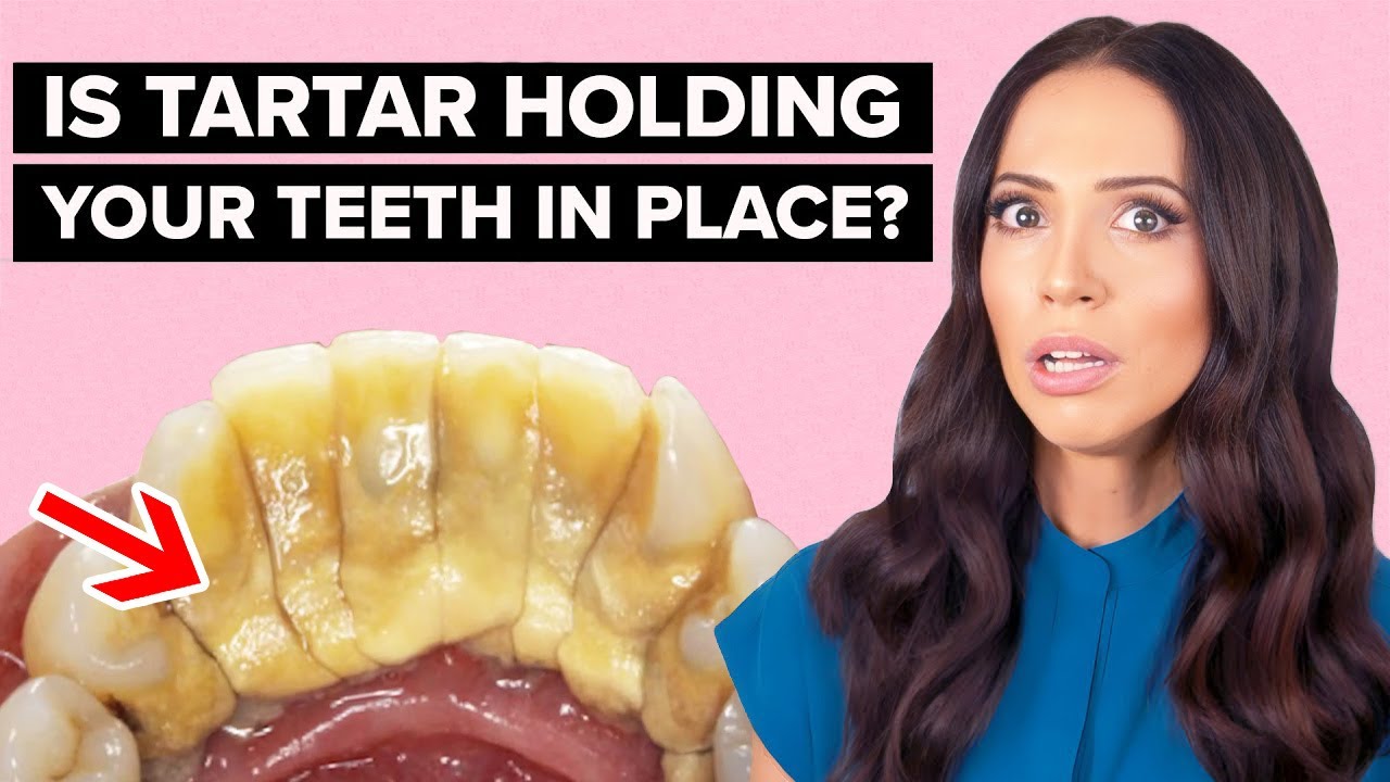 Is Tartar HOLDING Your Teeth In Place? (Calculus Bridge Explained ...